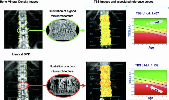 Trabecular Bone Score (TBS) – AR Bone Health LLC